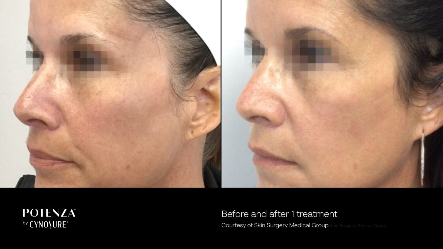 Potenza RF Microneedling - Rebel Med NW